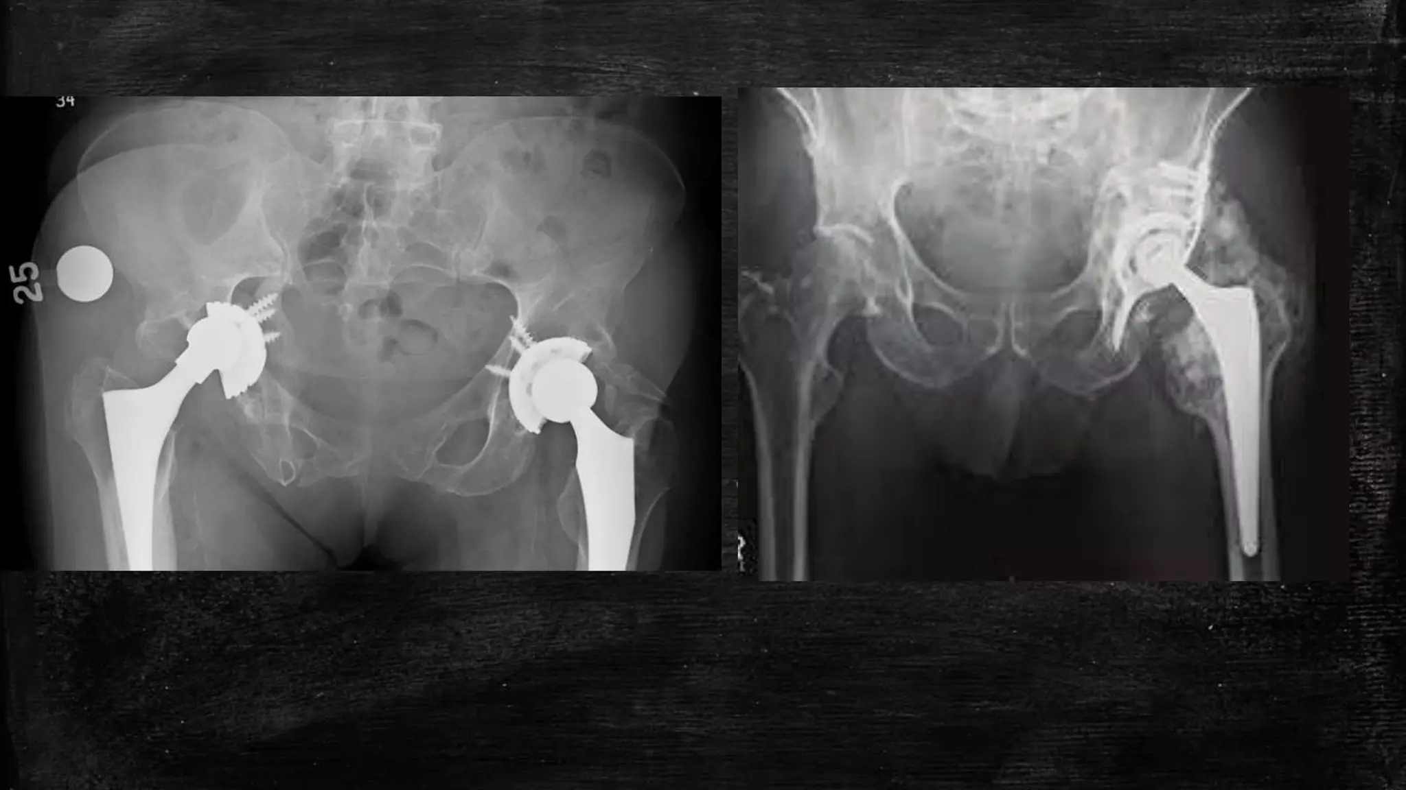 Periprosthetic fractures | PPTX
