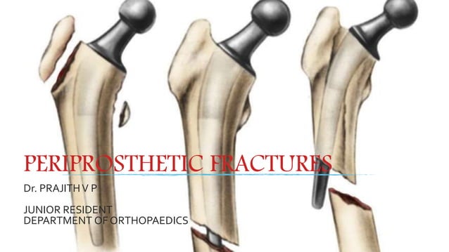 Periprosthetic fractures | PPTX