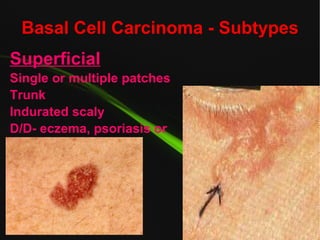 basal cell carcinoma | PPT