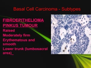basal cell carcinoma | PPT