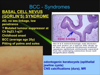 basal cell carcinoma | PPT