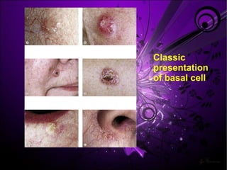 basal cell carcinoma | PPT