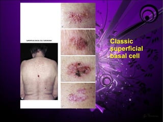 basal cell carcinoma | PPT