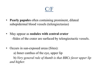 Basal cell carcinoma | PDF