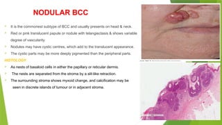 Basal cell carcinoma and sqamous cell ca | PPTX