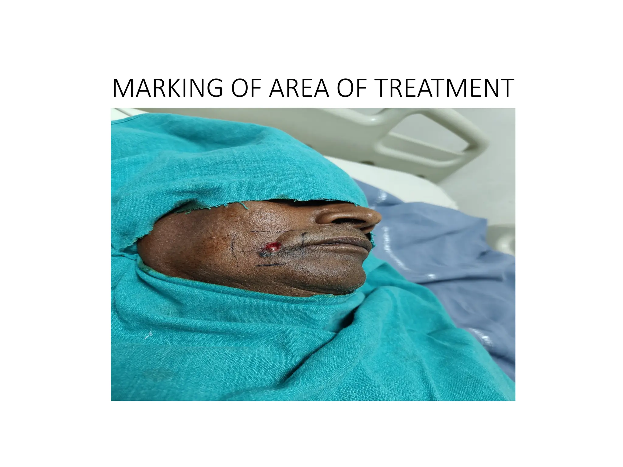 PROCEDURE OF INTERSTITIAL BRACHYTHERAPY FOR SKIN AND BUCCAL MUCOSA ...