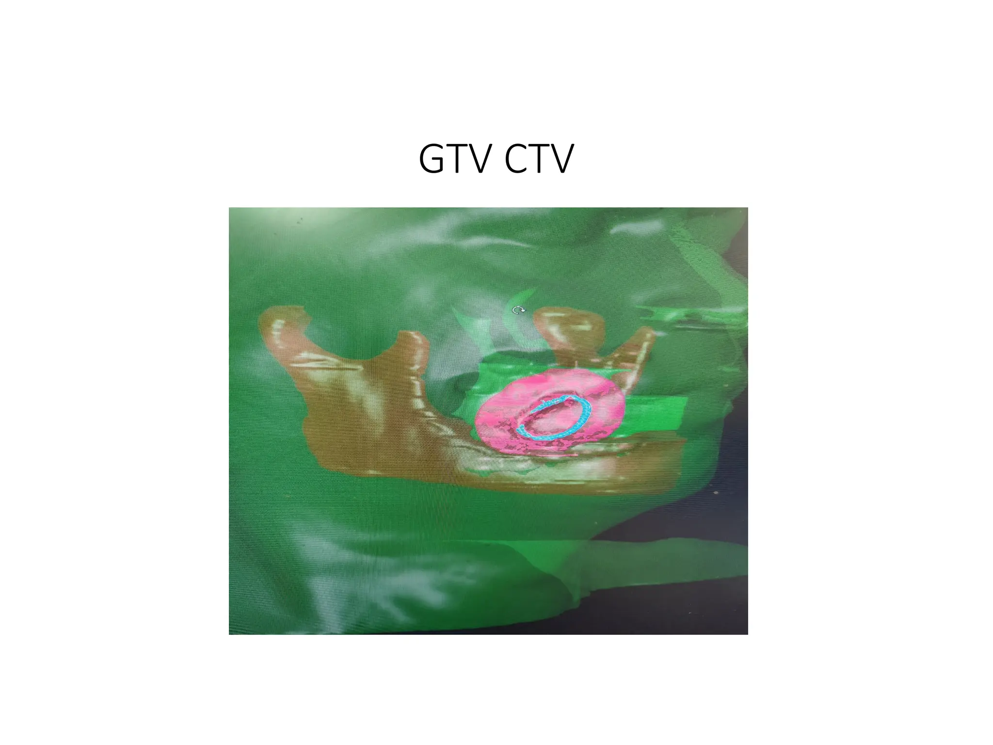 PROCEDURE OF INTERSTITIAL BRACHYTHERAPY FOR SKIN AND BUCCAL MUCOSA ...