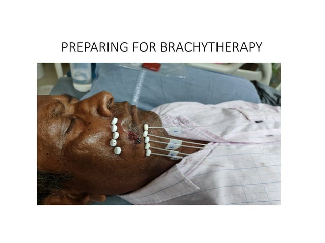PROCEDURE OF INTERSTITIAL BRACHYTHERAPY FOR SKIN AND BUCCAL MUCOSA ...