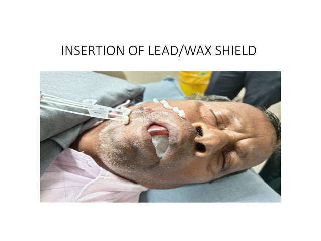 PROCEDURE OF INTERSTITIAL BRACHYTHERAPY FOR SKIN AND BUCCAL MUCOSA ...