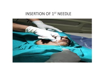 PROCEDURE OF INTERSTITIAL BRACHYTHERAPY FOR SKIN AND BUCCAL MUCOSA ...