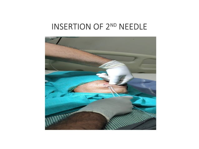 PROCEDURE OF INTERSTITIAL BRACHYTHERAPY FOR SKIN AND BUCCAL MUCOSA UNDER LOCAL ANAESTHESIA AS ...