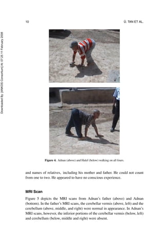 UNERTAN SYNDROME: A CASE SERIES DEMONSTRATING HUMAN DEVOLUTION | PDF