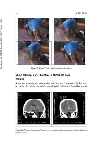 UNERTAN SYNDROME: A CASE SERIES DEMONSTRATING HUMAN DEVOLUTION | PDF