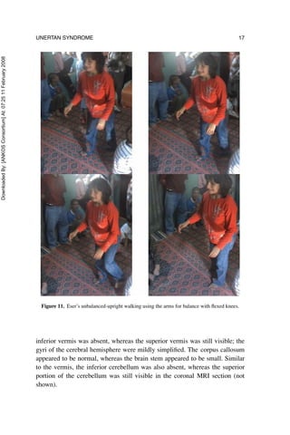 UNERTAN SYNDROME: A CASE SERIES DEMONSTRATING HUMAN DEVOLUTION | PDF