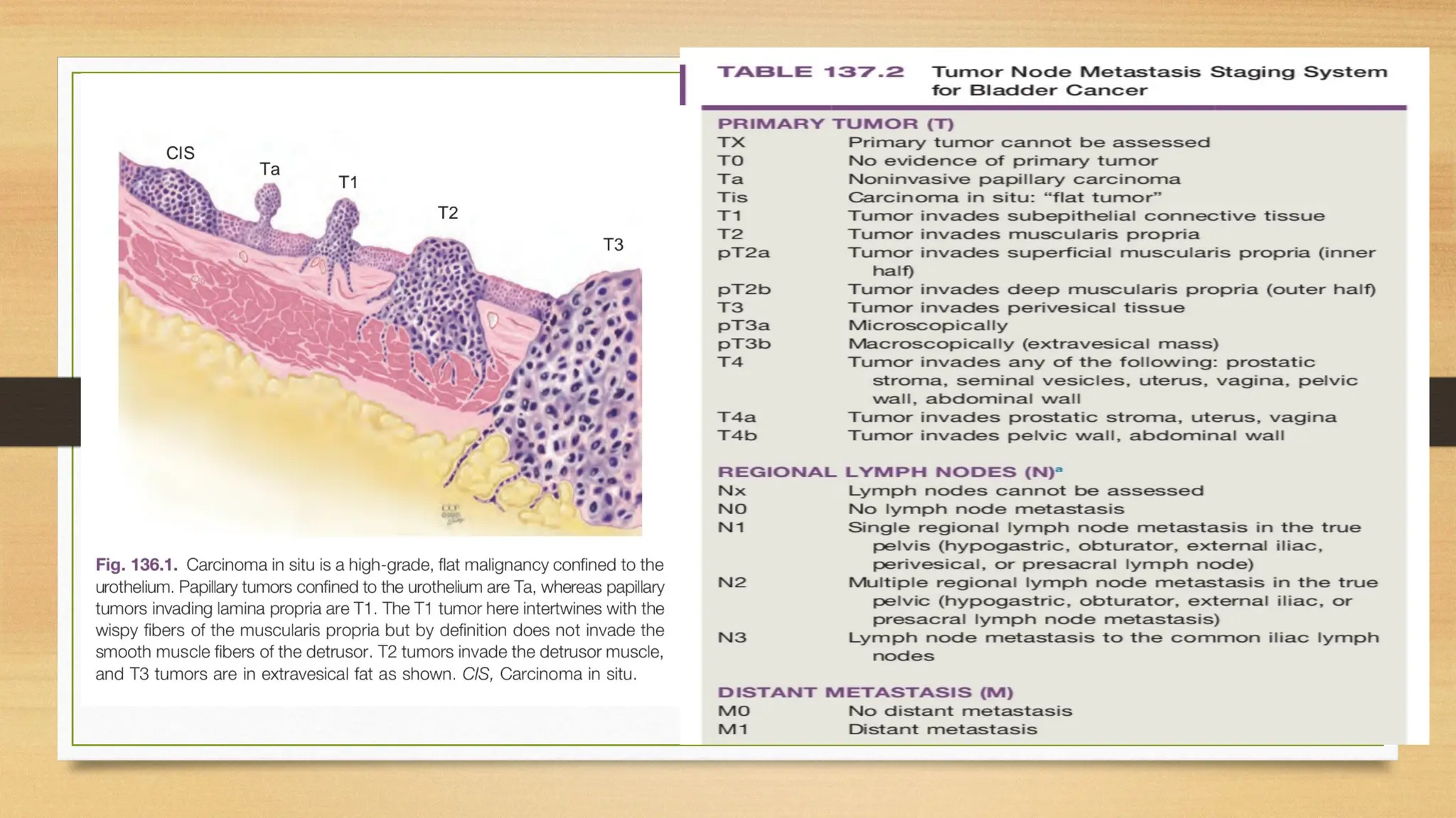 BCG therapy in Carcinoma of Bladder.pptx