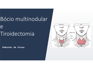 Aula sobre bócio. Tipos. Conduta cirúrgica .pdf