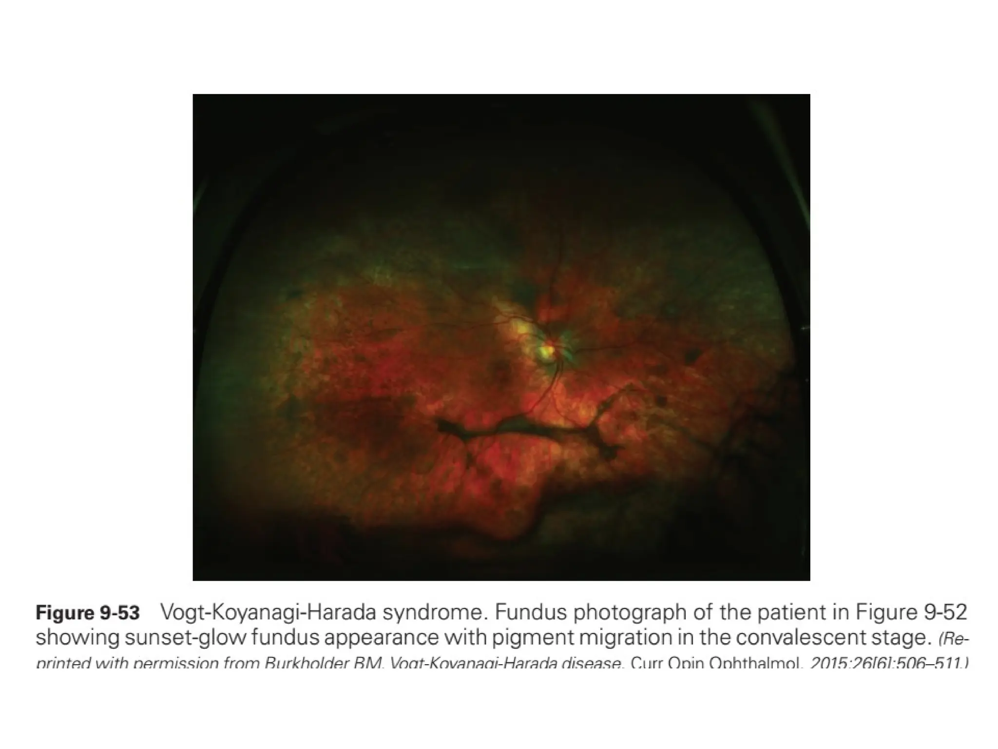 opththalmology BCSC Uveitis Part 2.pptx