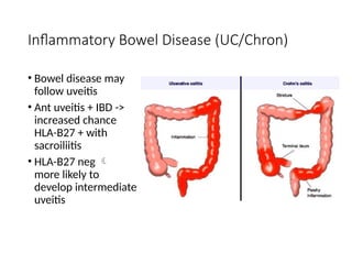 opththalmology BCSC Uveitis Part 2.pptx