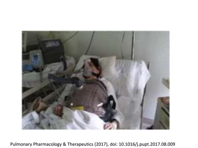 Biphasic Cuirass Ventilation for Respiratory Failure and ARDS | PPT ...