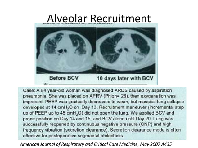 Biphasic Cuirass Ventilation for Respiratory Failure and ARDS | PPT ...