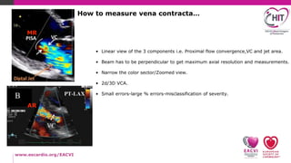 Basic concepts of valvular regurgitation-Echocardiography | PPTX