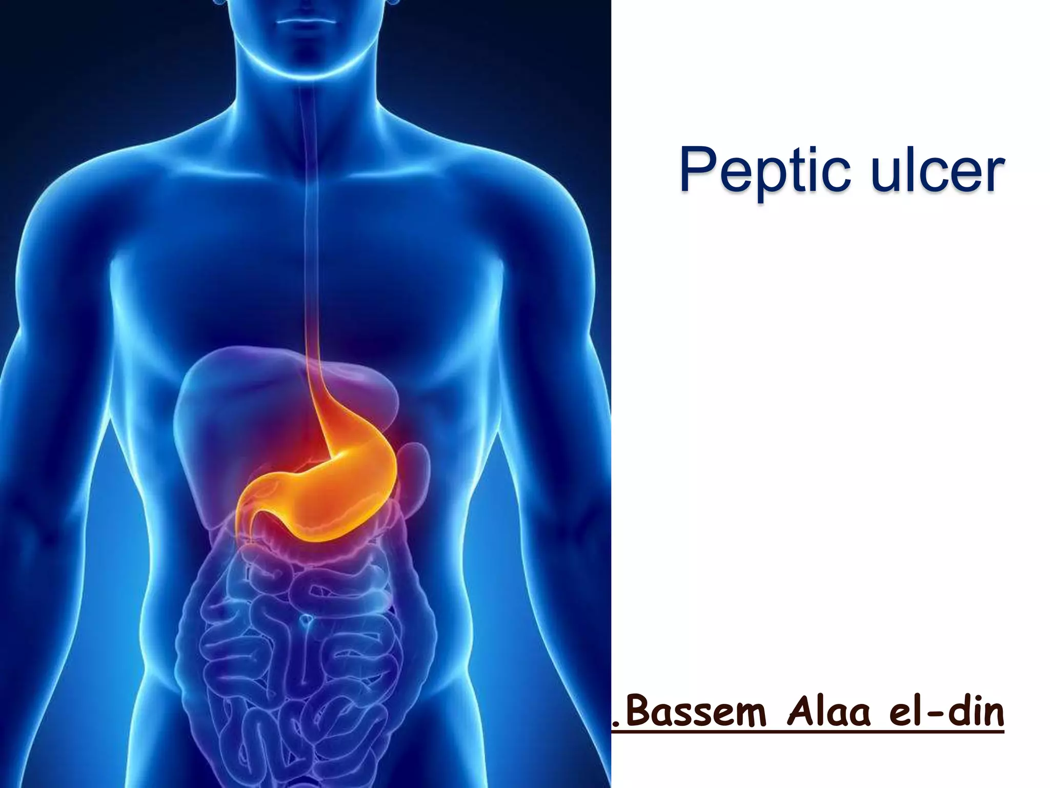 PEPTIC ULCER | PPTX | Digestive Disorders | Diseases and Conditions