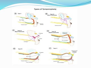MYRINGOTOMY, | PDF