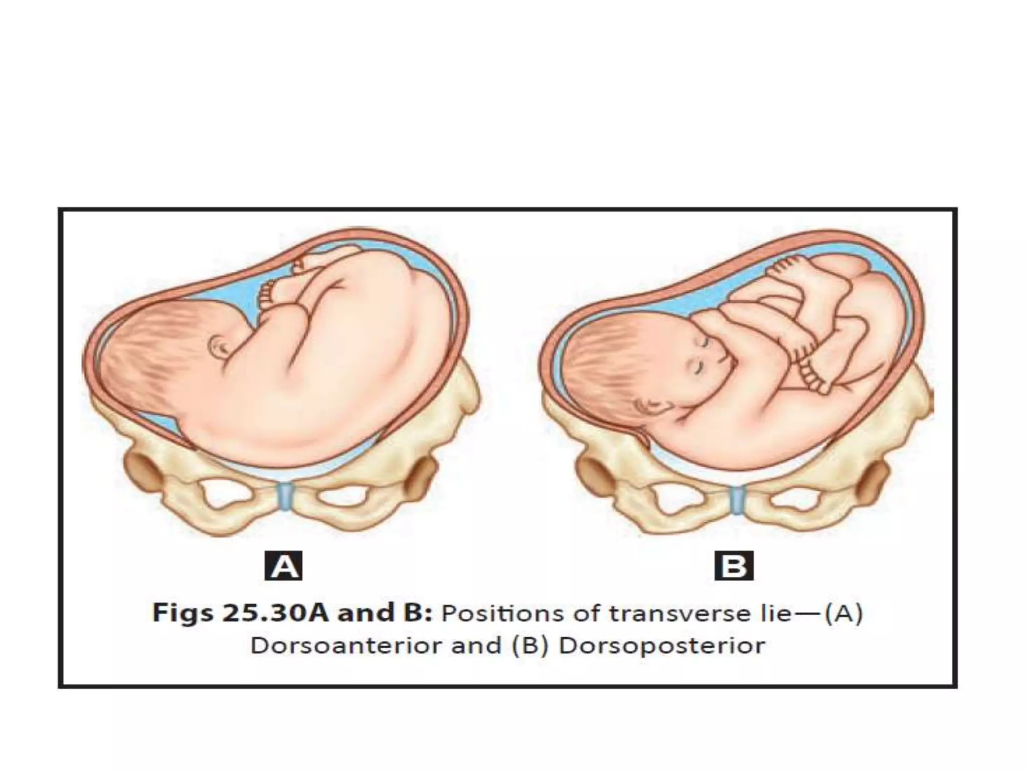 Transverse lie and cord prolapse | PPTX