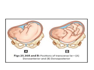 Transverse lie and cord prolapse | PPTX