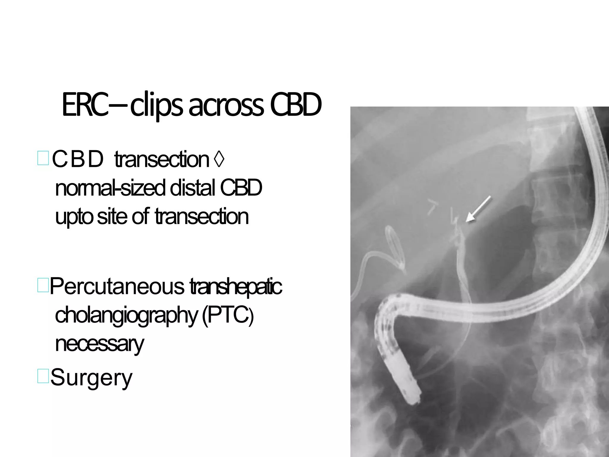 Bile duct injuries | PPTX