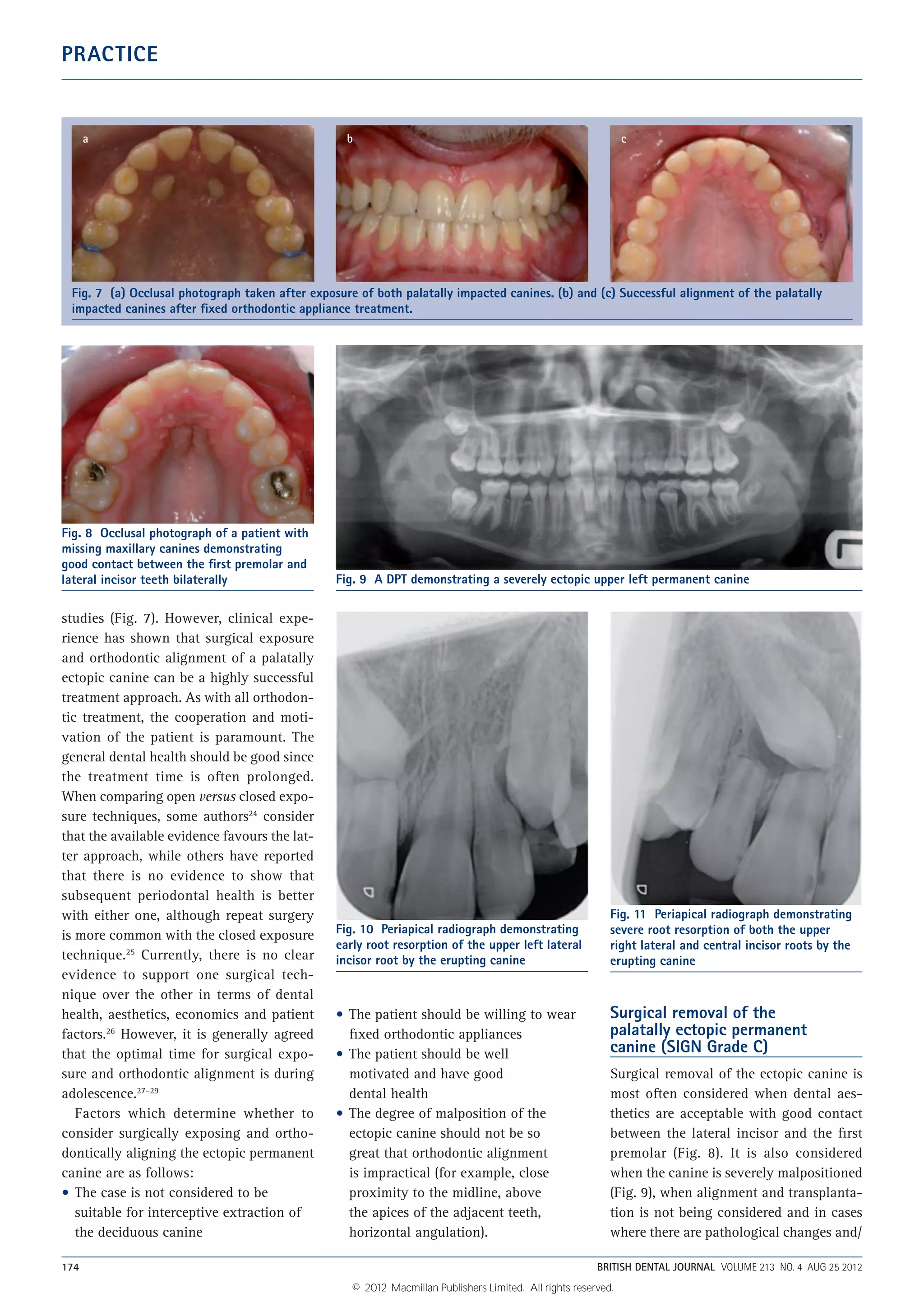 Bdj 2012. national_clinical_guidelines_for_management_of_the_palatally ...