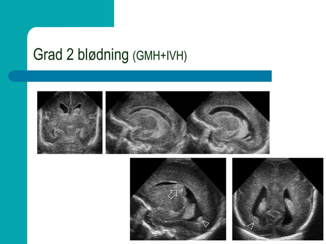 Cerebral ultralyd | PPT