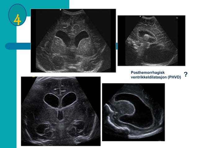 Cerebral ultralyd | PPT