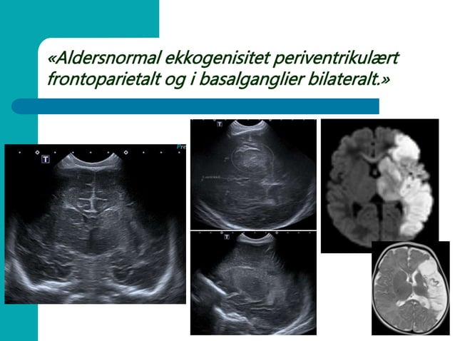 Cerebral ultralyd | PPT