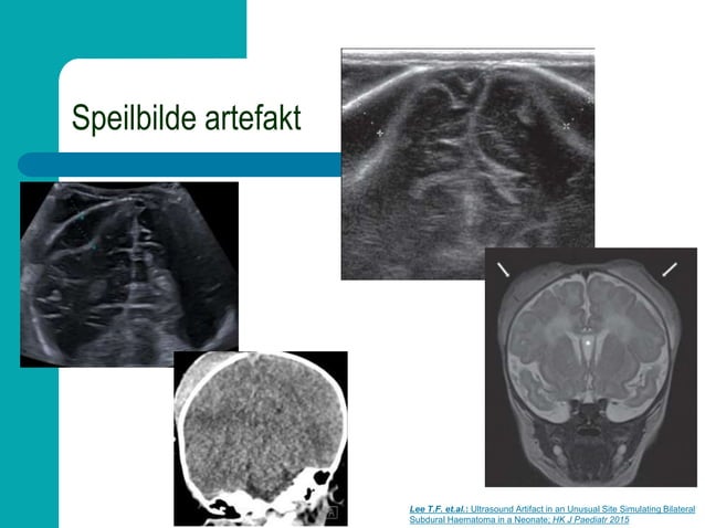 Cerebral ultralyd | PPT