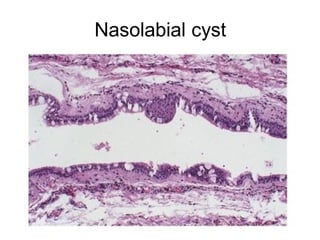 BDS 2022 cysts of oral and perioral soft tissues.ppt