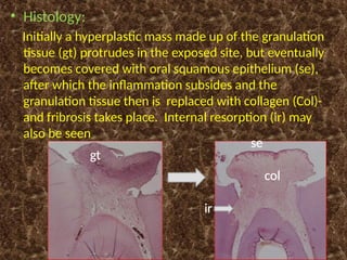 BDS_2025_Sequelae_of_Dental_caries,_resorption,_hypercementosis.pptx