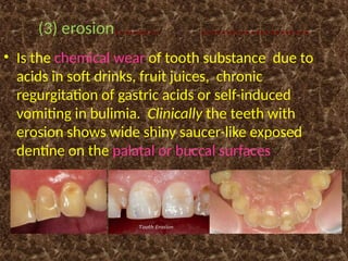 BDS_2025_Sequelae_of_Dental_caries,_resorption,_hypercementosis.pptx