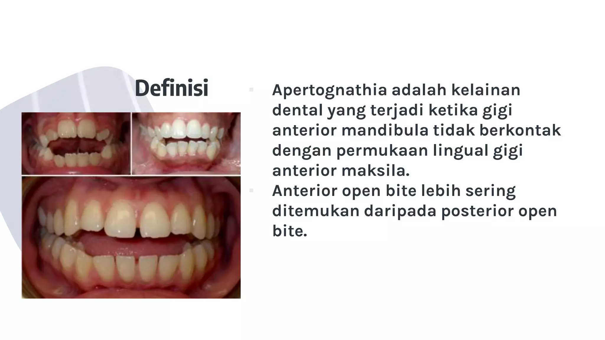 Jenis-jenis Maloklusi (Malposisi, Crowding, Open Bite) | PPTX
