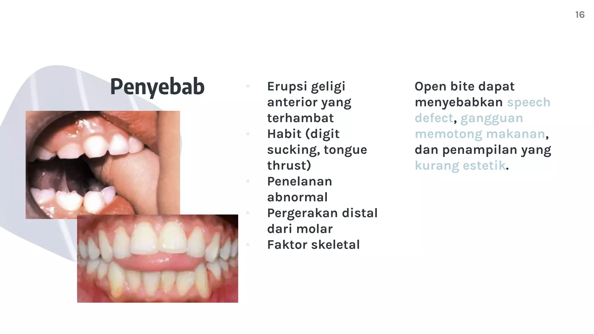 Jenis-jenis Maloklusi (Malposisi, Crowding, Open Bite) | PPTX
