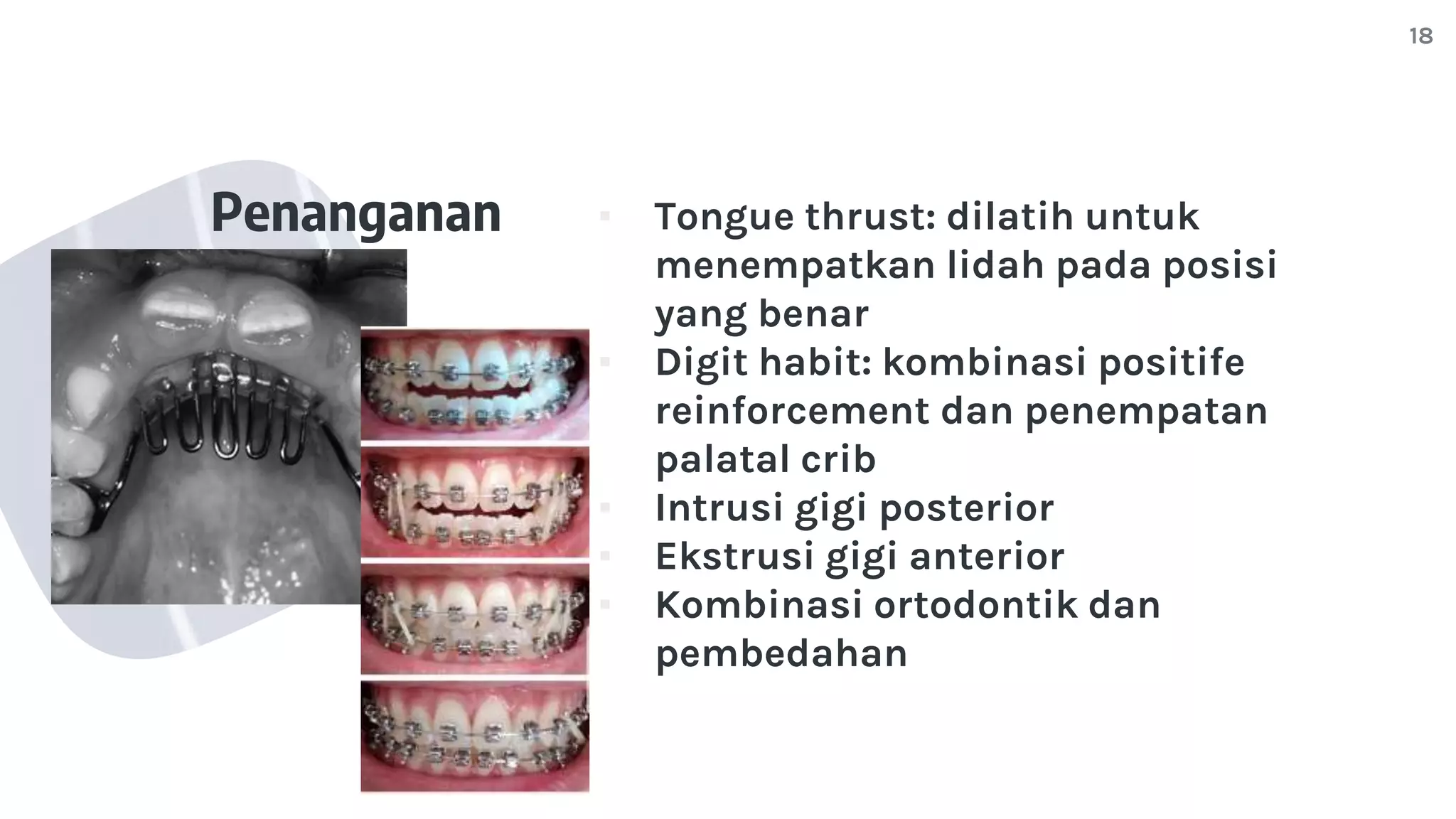 Jenis-jenis Maloklusi (Malposisi, Crowding, Open Bite) | PPTX