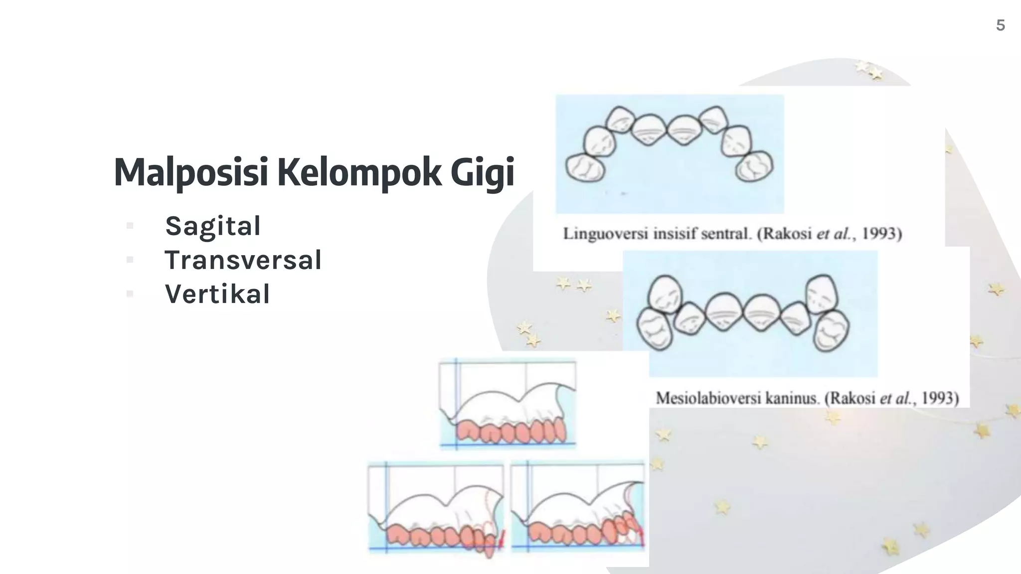 Jenis-jenis Maloklusi (Malposisi, Crowding, Open Bite) | PPTX