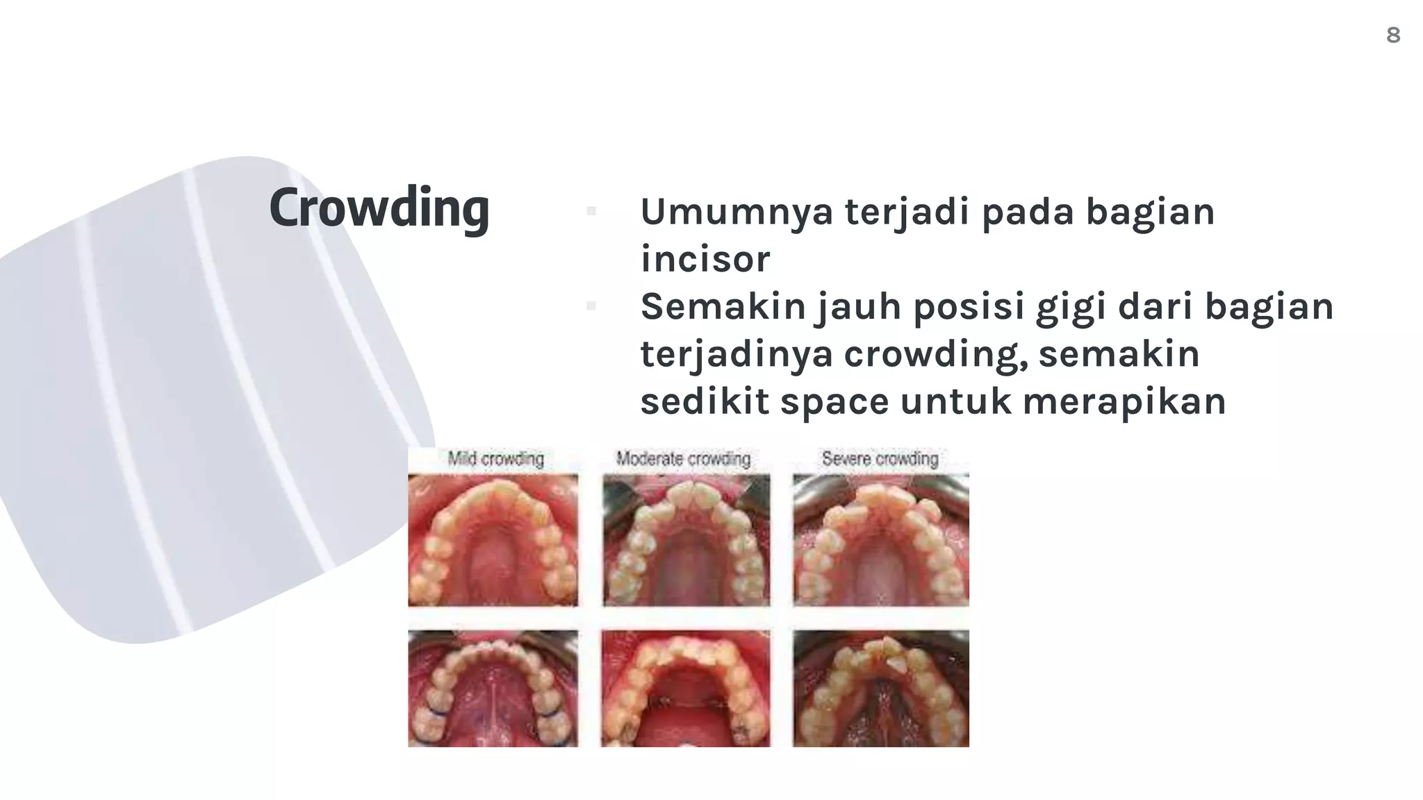 Jenis-jenis Maloklusi (Malposisi, Crowding, Open Bite) | PPTX