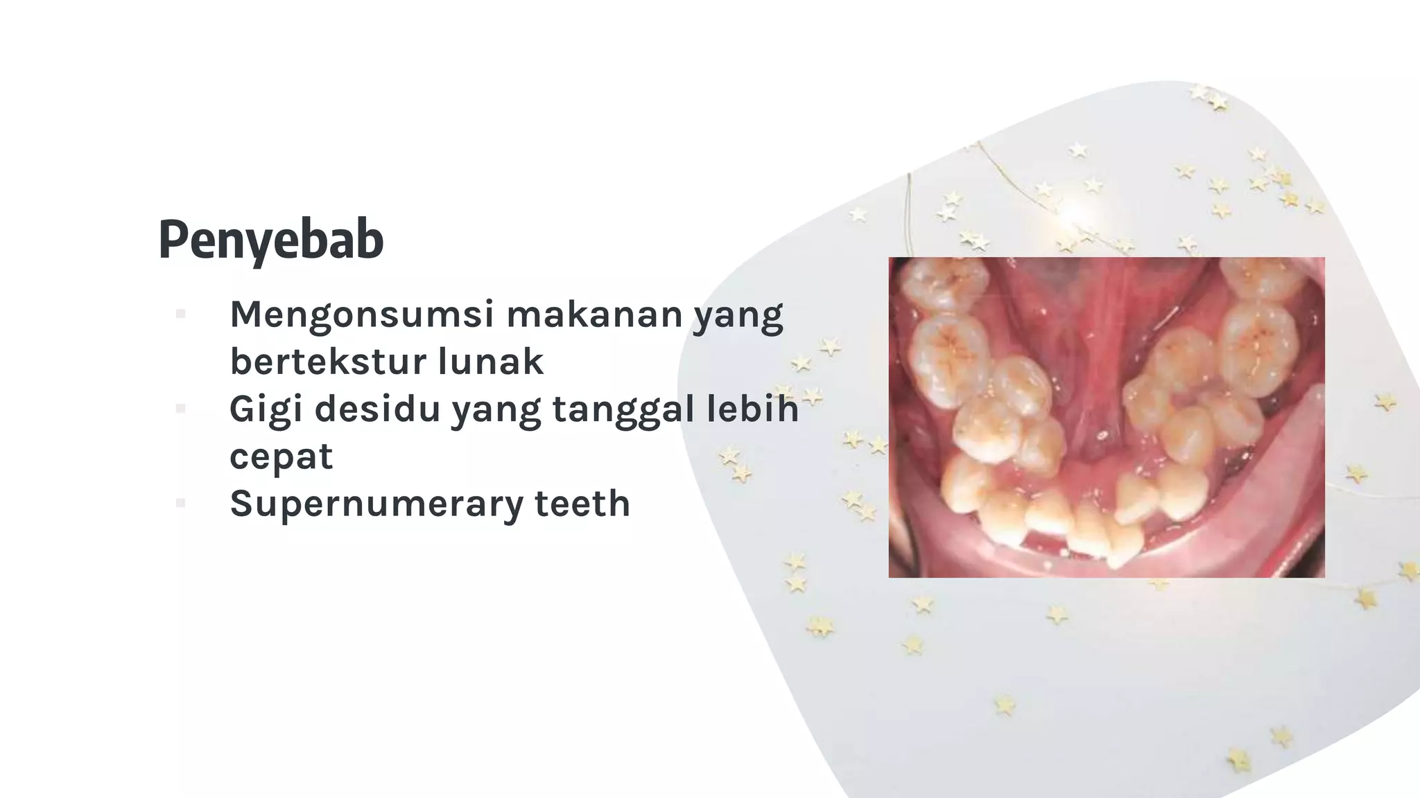 Jenis-jenis Maloklusi (Malposisi, Crowding, Open Bite) | PPTX