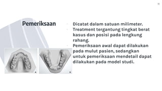 Jenis-jenis Maloklusi (Malposisi, Crowding, Open Bite) | PPTX
