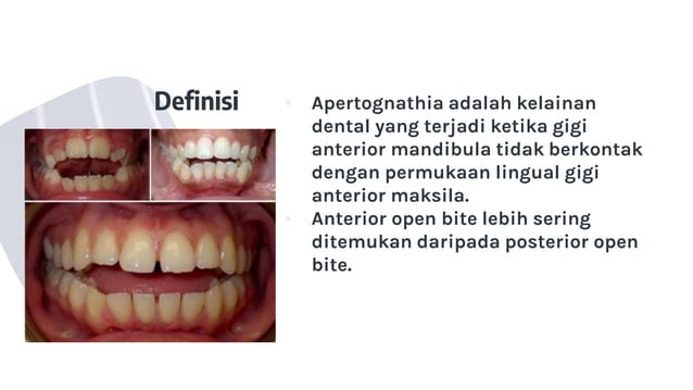 Jenis-jenis Maloklusi (Malposisi, Crowding, Open Bite) | PPTX