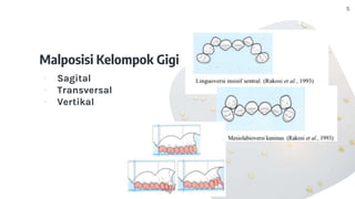 Jenis-jenis Maloklusi (Malposisi, Crowding, Open Bite) | PPTX