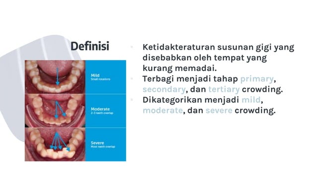 Jenis-jenis Maloklusi (Malposisi, Crowding, Open Bite) | PPT