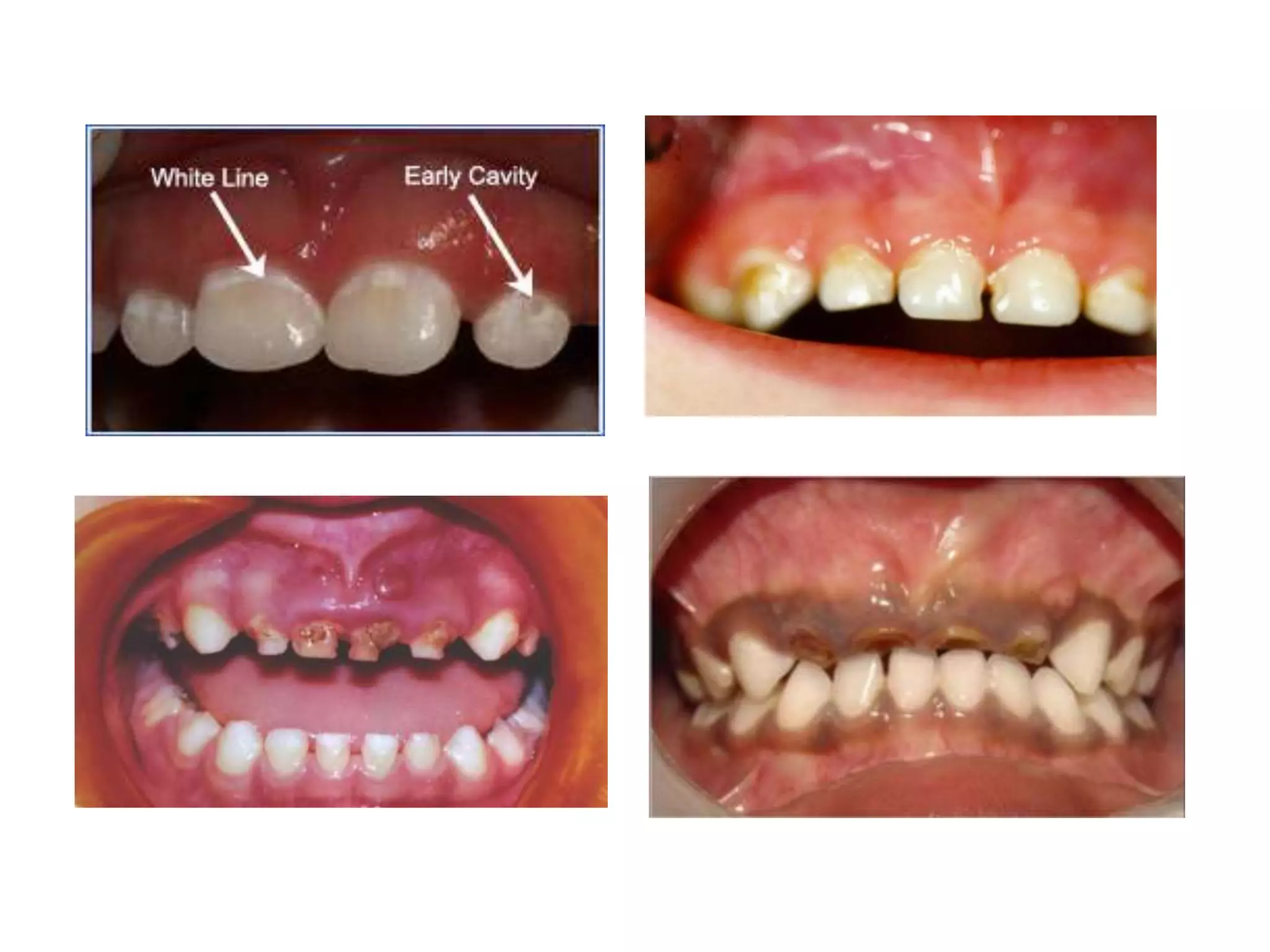 Nursing Mouth Caries | PPT
