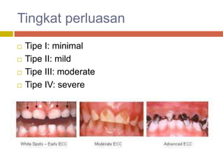 Nursing Mouth Caries | PPT